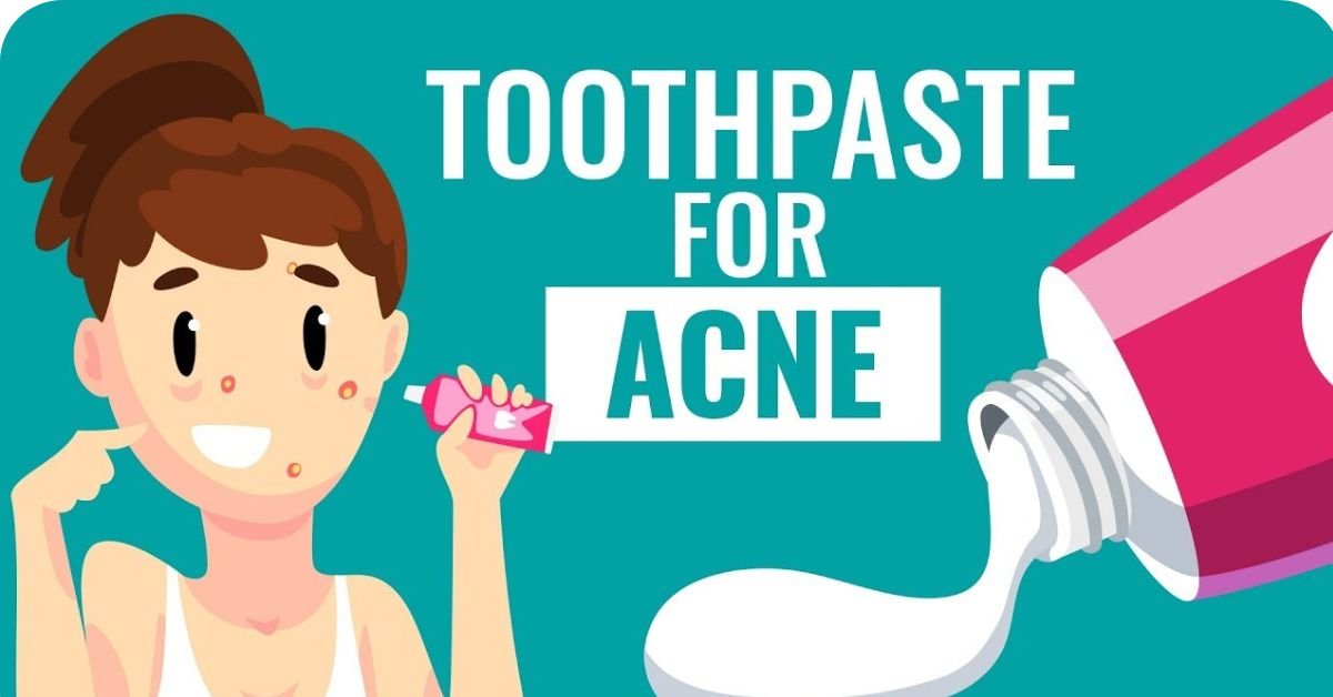 Should you use Toothpaste to Treat Pimple? Get The Answers | Fashna